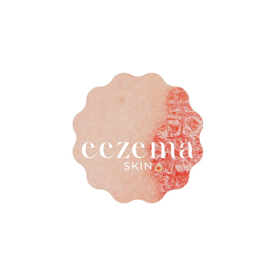 Skincare treatmnets for eczema, atopic dermatitis skin - Narellan ...
