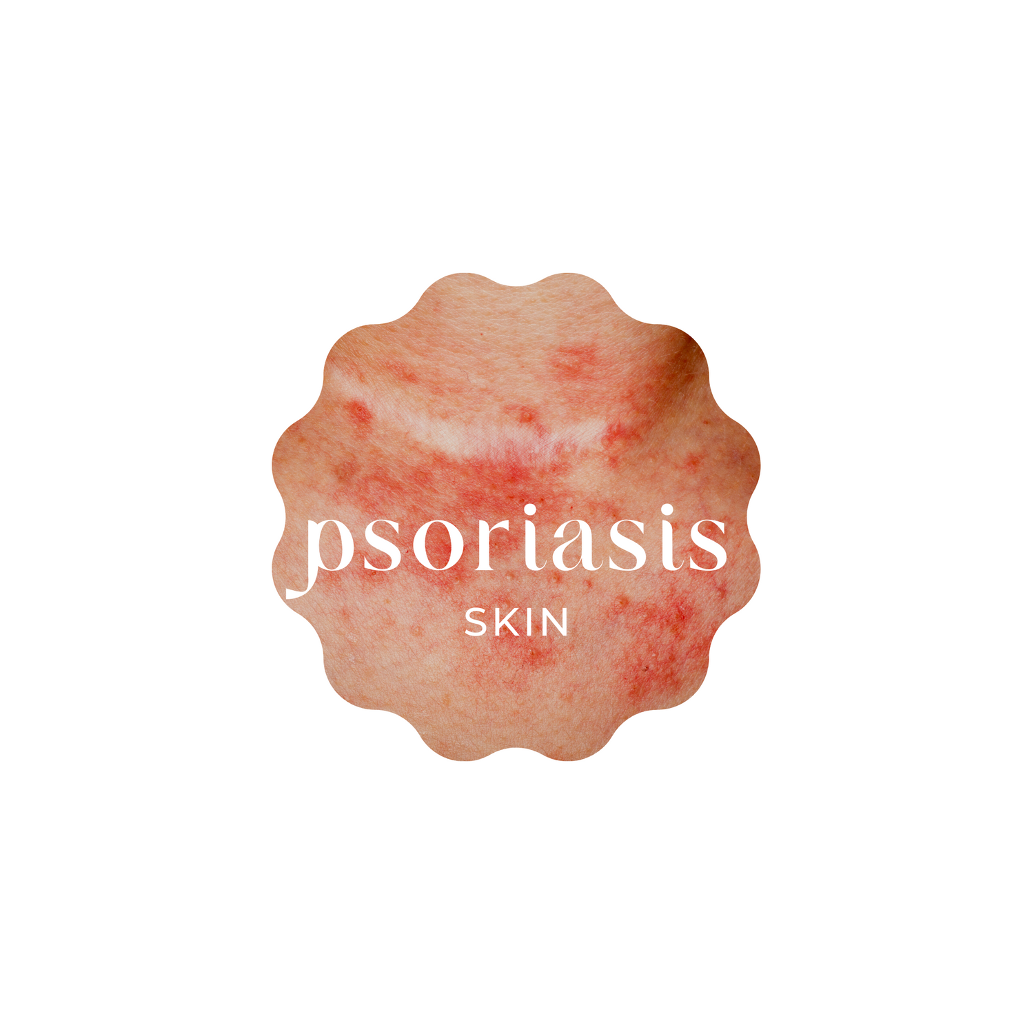 Products Treatments for Psoriasis skin condition - Narellan Skin Salon ...