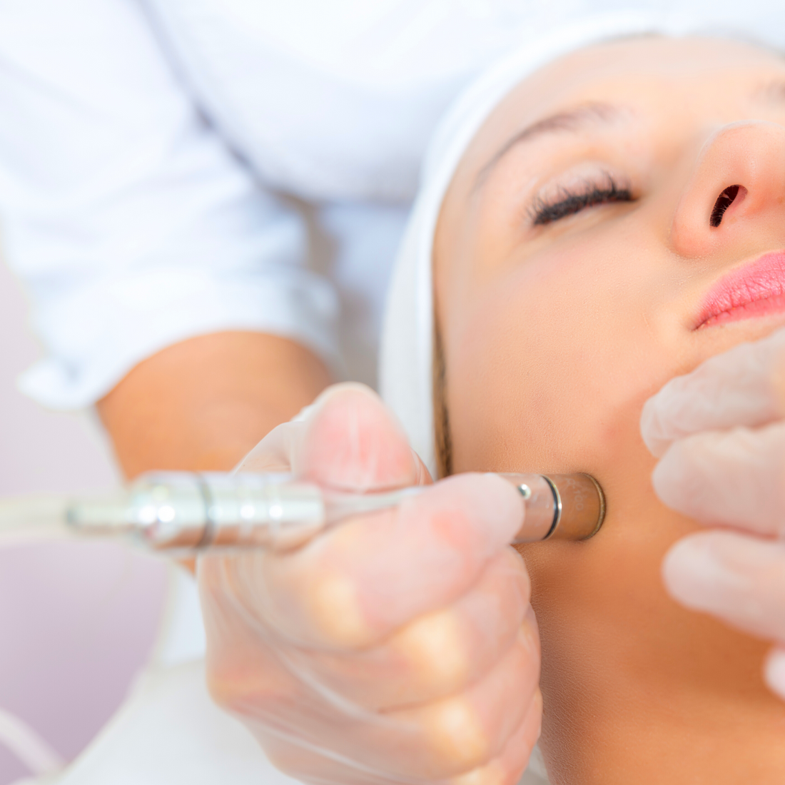 Medical Microdermabrasion with Mask and Infusion Facial - Narellan NSW ...